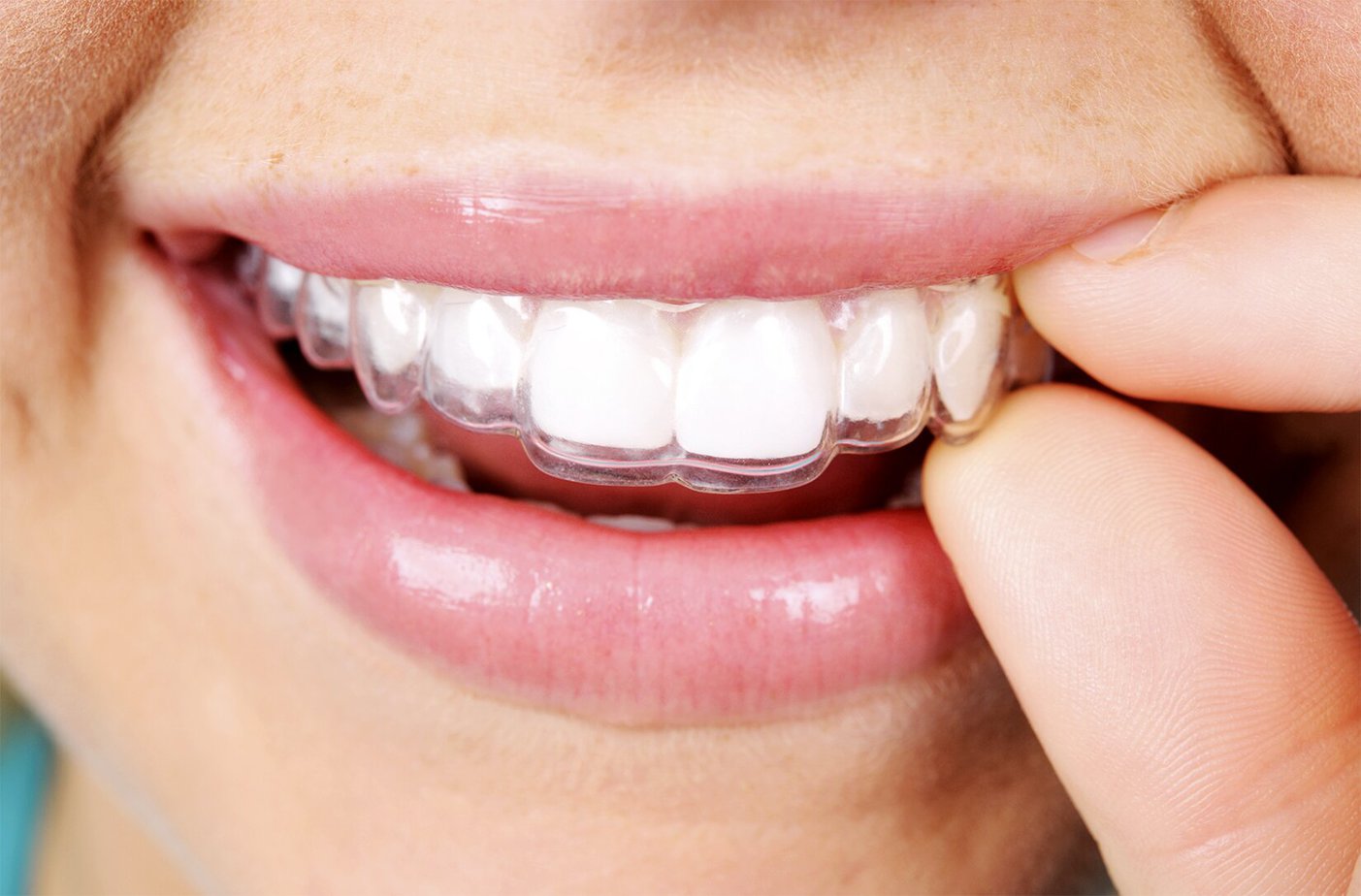 Byte vs Invisalign: Everything You Need To Know About Two Popular ...