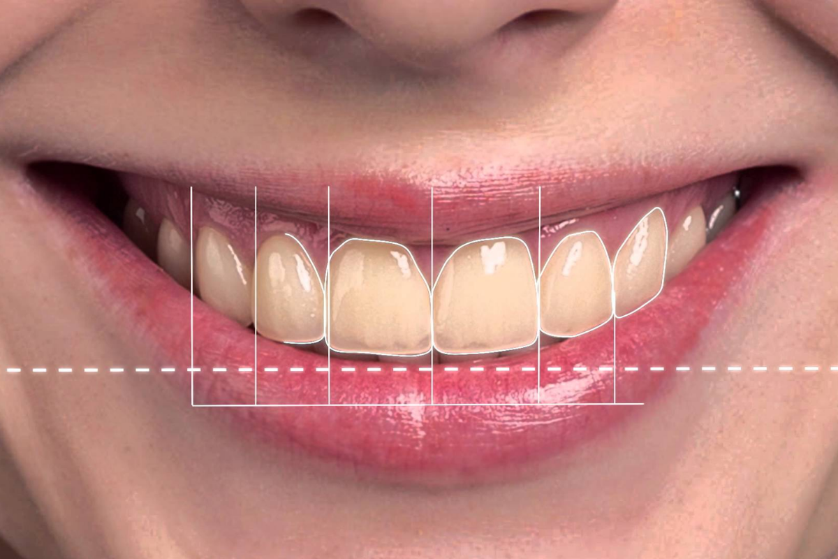 How Does Digital Design Smile Work? | Burwood Dental Care